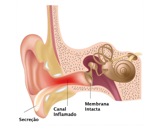 Otite Externa - Dr. Douglas Ribeiro